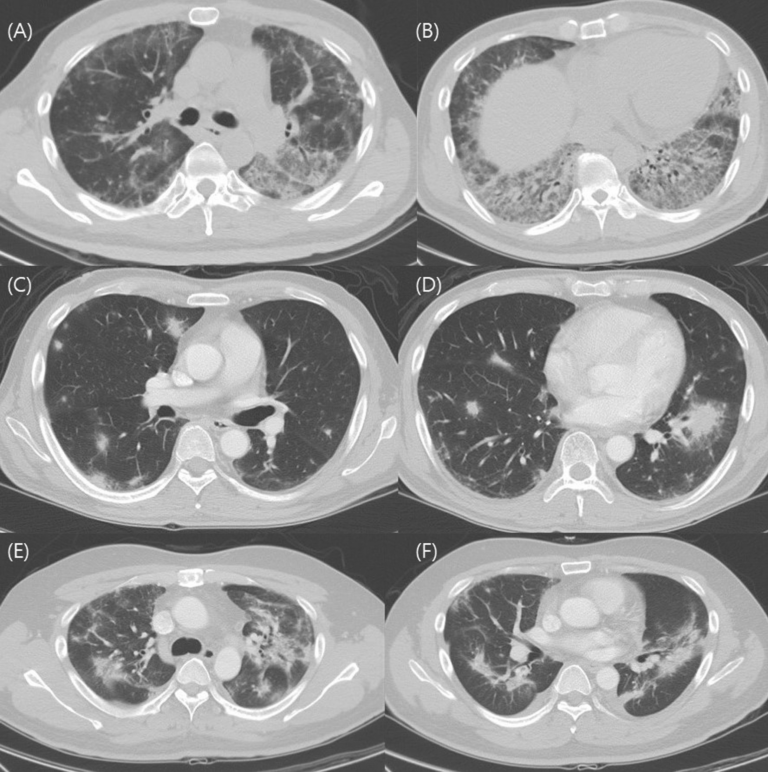 急性纤维素性机化性肺炎（AFOP） | 每周呼吸-每周呼吸