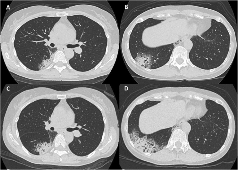急性纤维素性机化性肺炎（AFOP） | 每周呼吸-每周呼吸