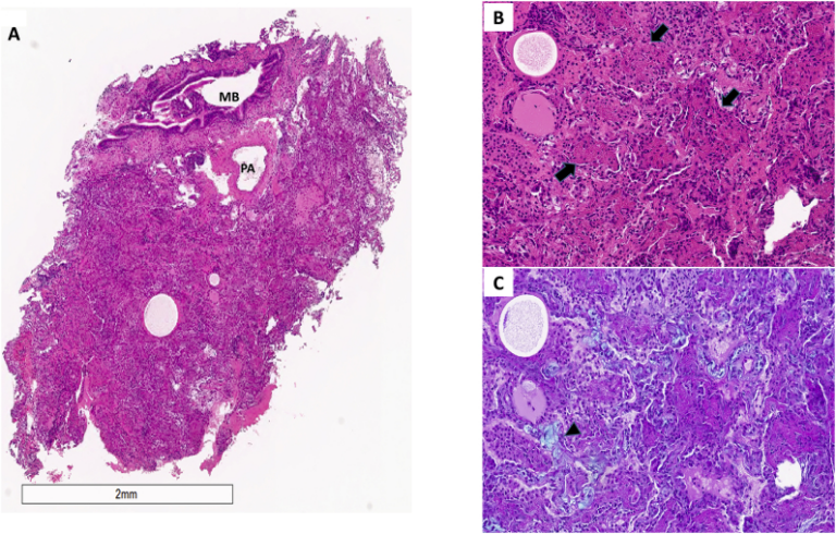 急性纤维素性机化性肺炎（AFOP） | 每周呼吸-每周呼吸